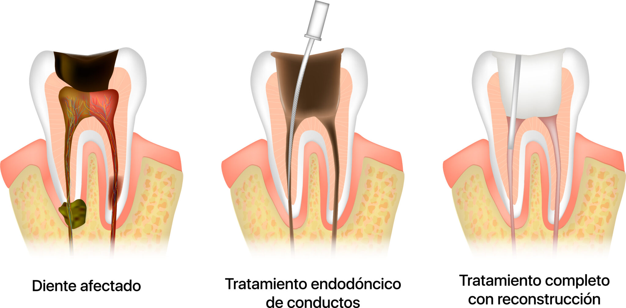 Endodoncia - Dr. Ramón Palomero